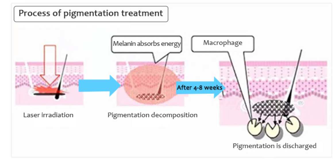 What is picosecond laser?